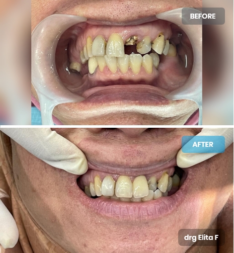 Pemasangan Gigi Tiruan - Griya Denta